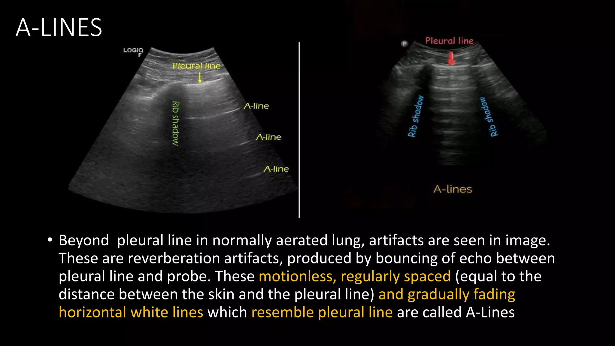 USG THORAX [Autosaved].pptx