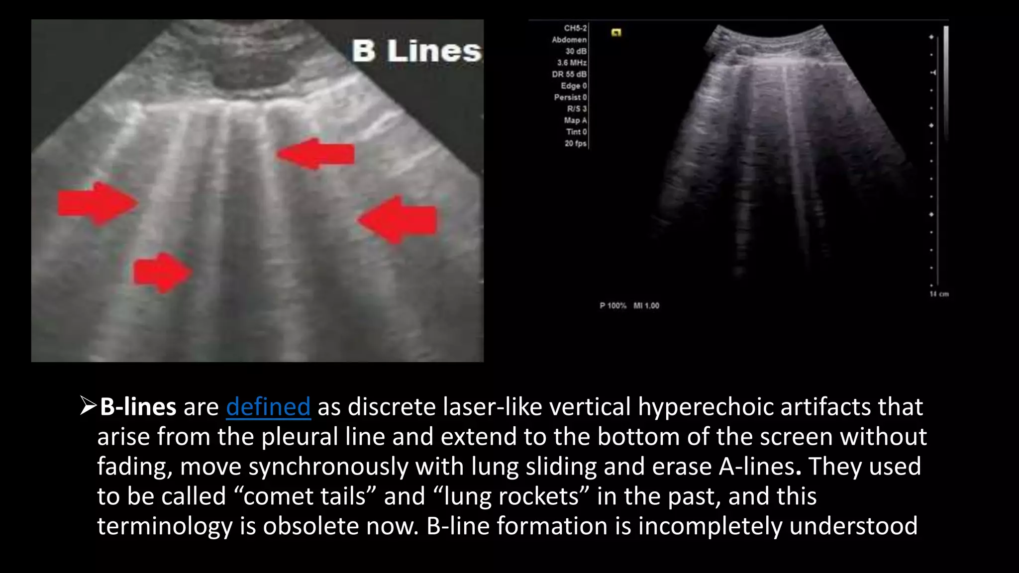 USG THORAX [Autosaved].pptx