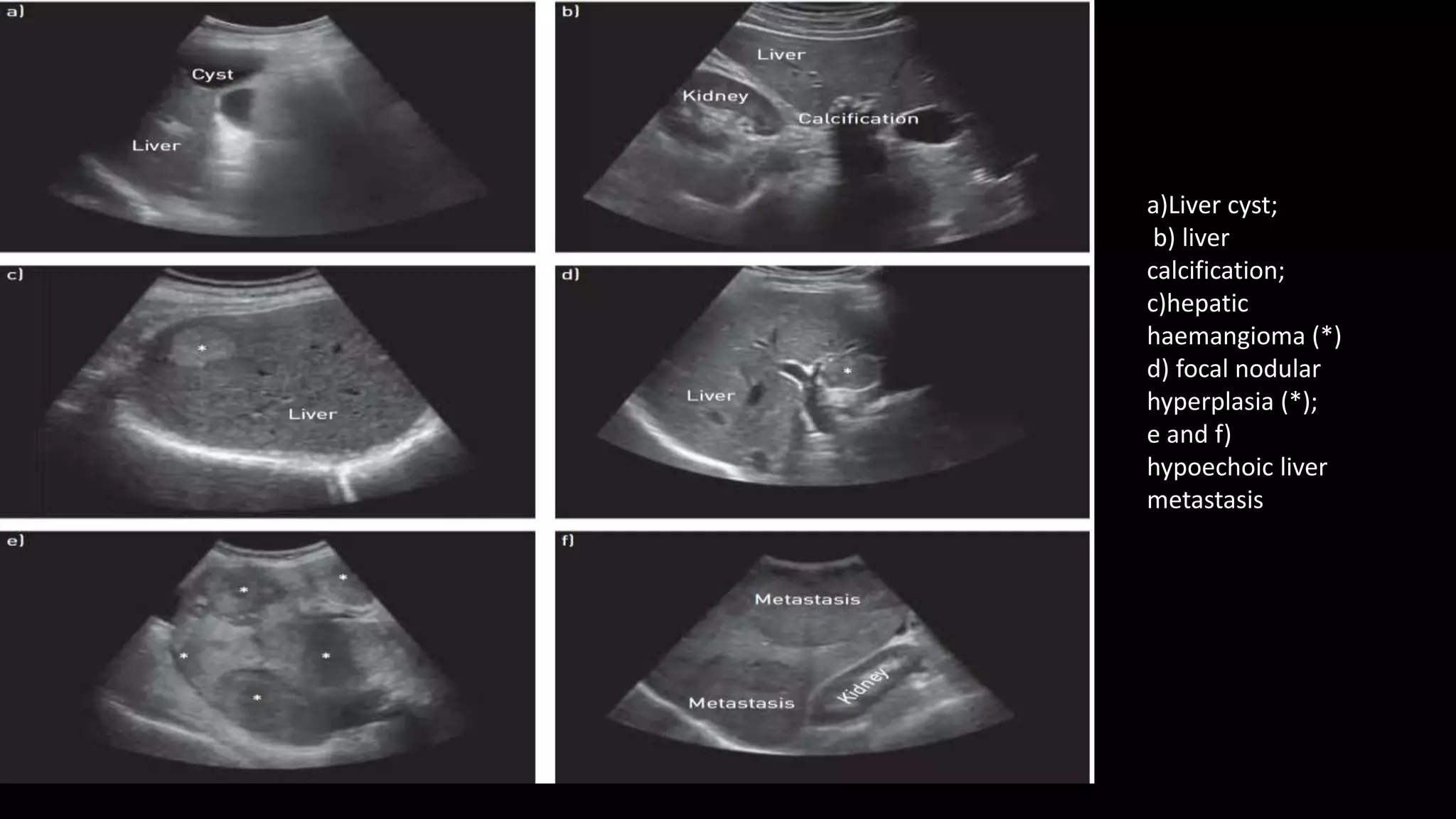 USG THORAX [Autosaved].pptx | Lung and Respiratory Health | Diseases ...