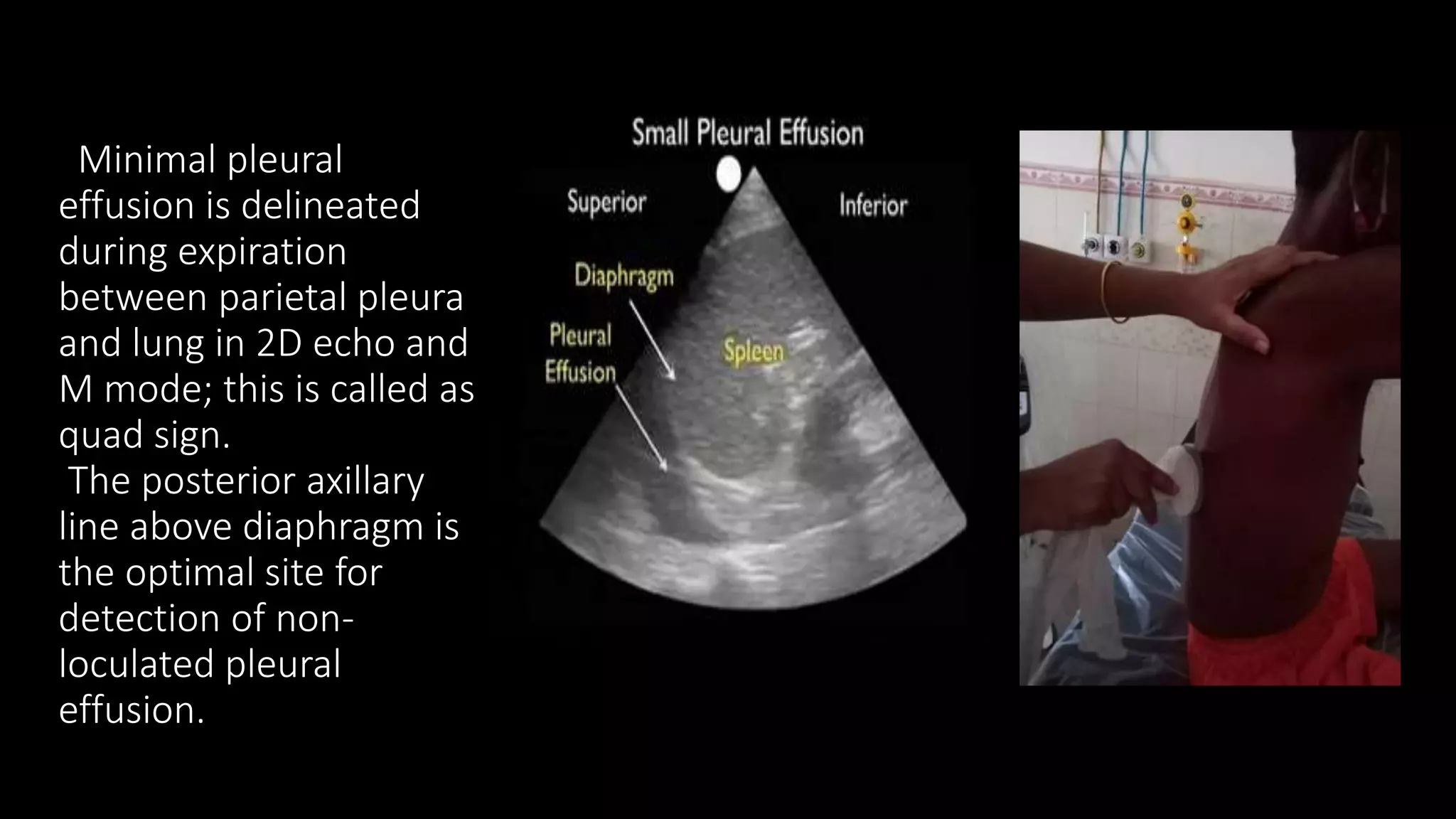 USG THORAX [Autosaved].pptx