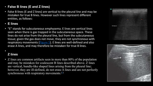 USG THORAX [Autosaved].pptx | Lung and Respiratory Health | Diseases ...