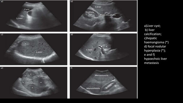 USG THORAX [Autosaved].pptx | Lung and Respiratory Health | Diseases ...