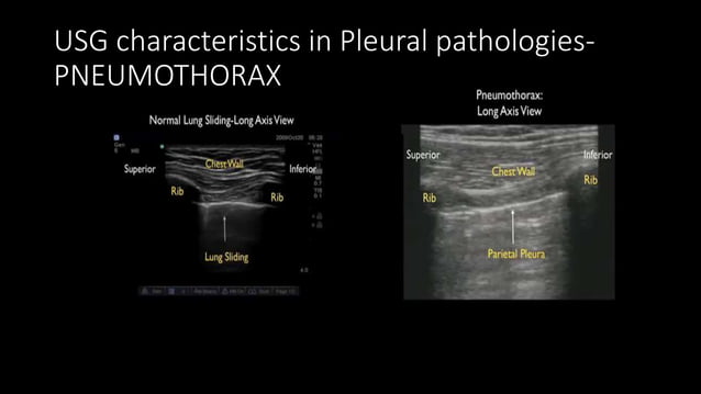 USG THORAX [Autosaved].pptx | Lung and Respiratory Health | Diseases ...