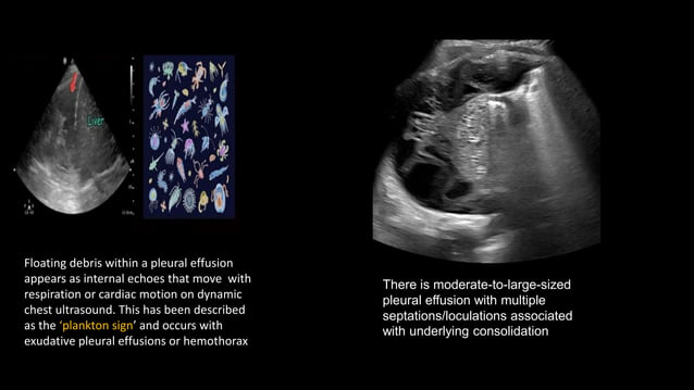 USG THORAX [Autosaved].pptx | Lung and Respiratory Health | Diseases ...