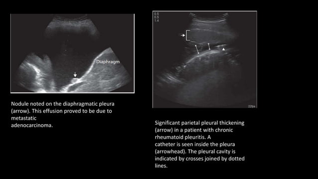 USG THORAX [Autosaved].pptx | Lung and Respiratory Health | Diseases ...
