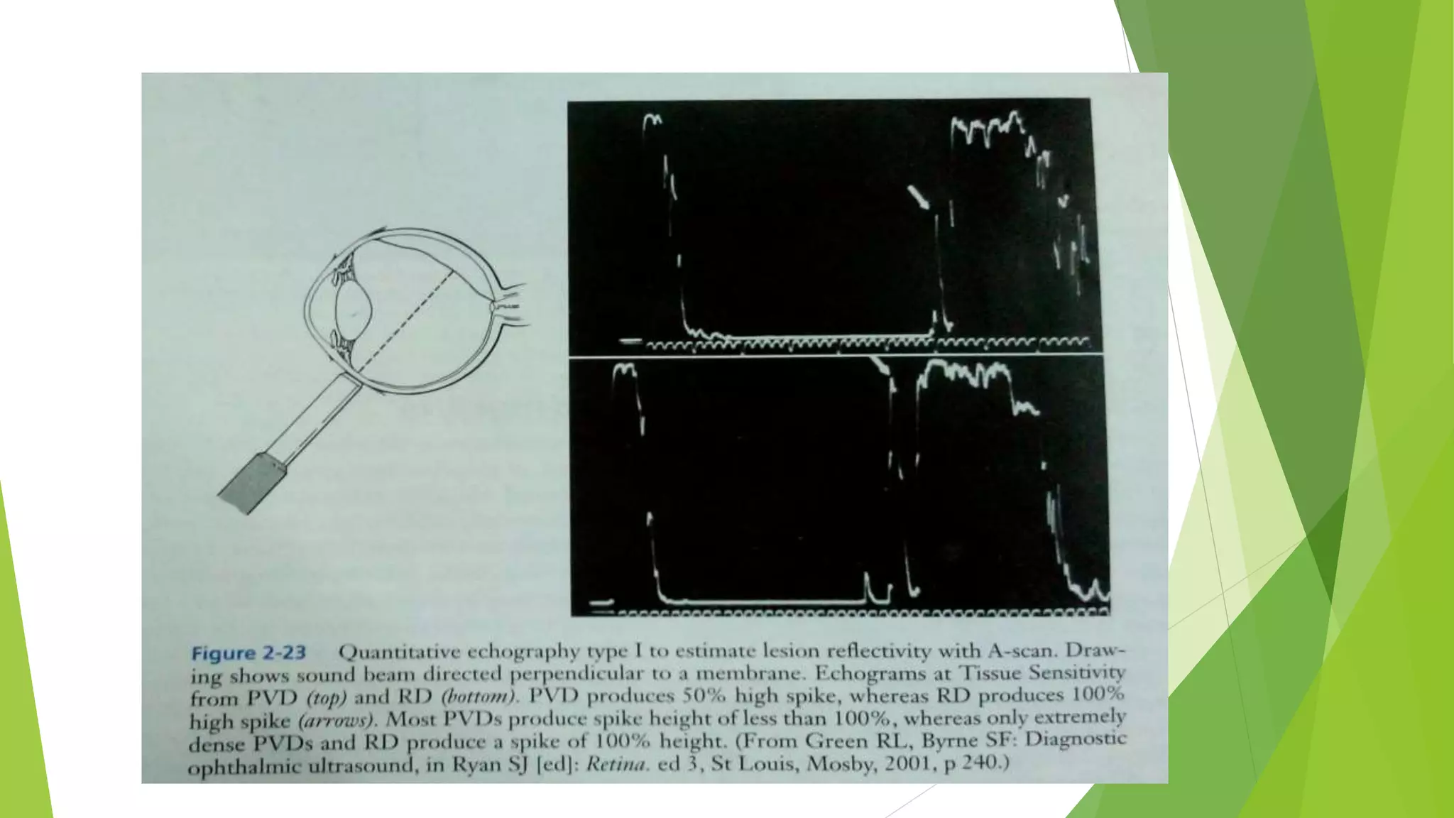 ULTRASONOGRAPHY (USG) AND ULTRASOUND BIOMICROSCOPY(UBM) | PPTX