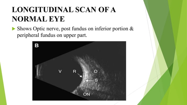 ULTRASONOGRAPHY (USG) AND ULTRASOUND BIOMICROSCOPY(UBM) | PPTX
