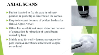 ULTRASONOGRAPHY (USG) AND ULTRASOUND BIOMICROSCOPY(UBM) | PPTX