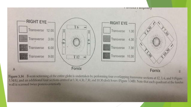 ULTRASONOGRAPHY (USG) AND ULTRASOUND BIOMICROSCOPY(UBM) | PPTX