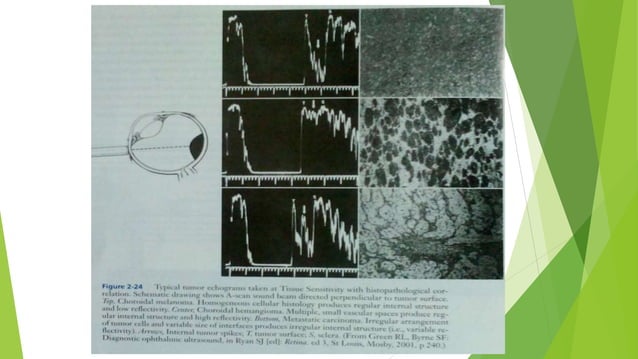 ULTRASONOGRAPHY (USG) AND ULTRASOUND BIOMICROSCOPY(UBM) | PPTX