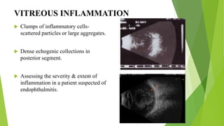 ULTRASONOGRAPHY (USG) AND ULTRASOUND BIOMICROSCOPY(UBM) | PPTX