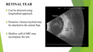 ULTRASONOGRAPHY (USG) AND ULTRASOUND BIOMICROSCOPY(UBM) | PPTX