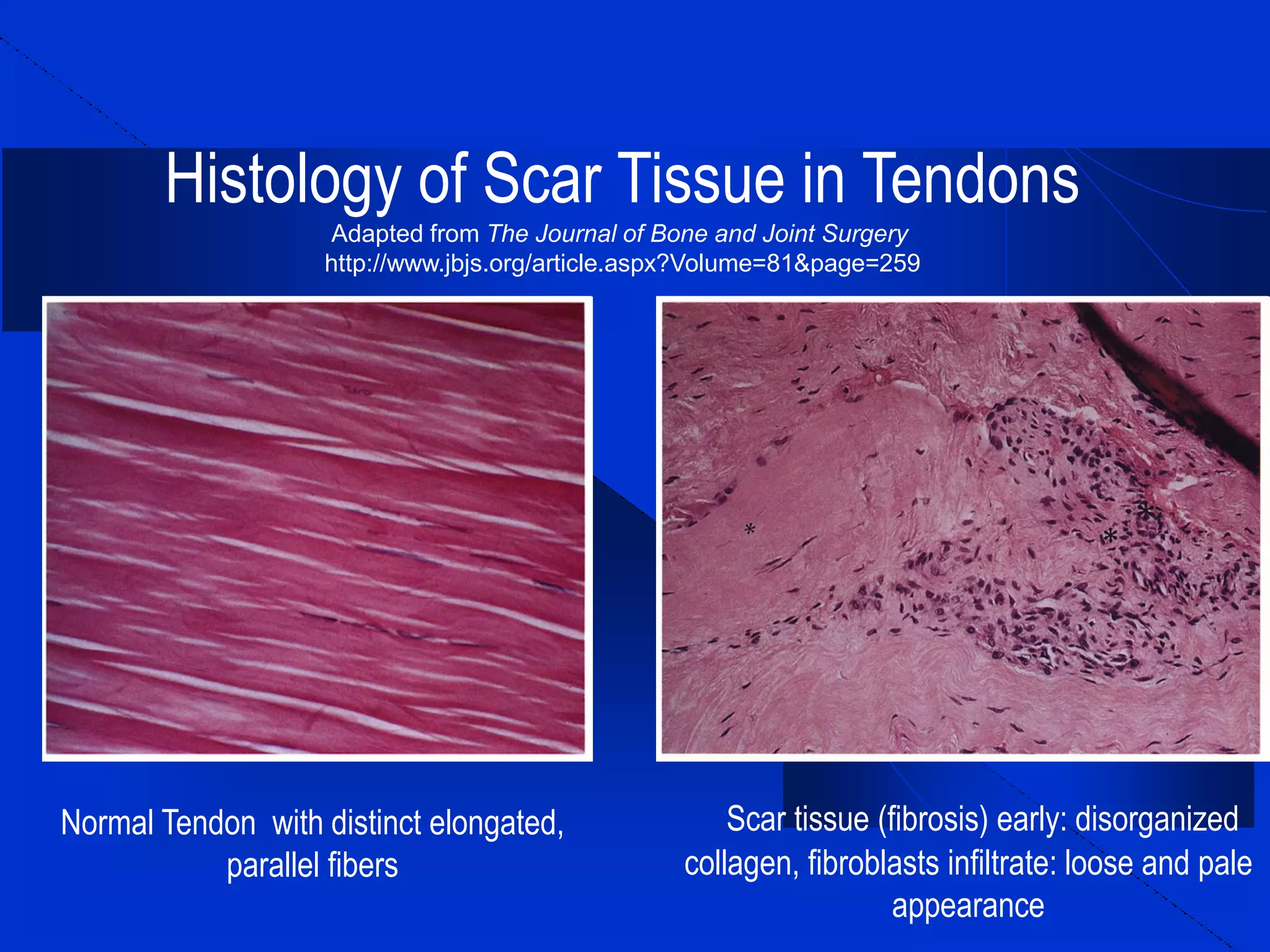 Ultrasound Guided Injectional Treatment of Scar Tissue, Bone Spurs, and ...
