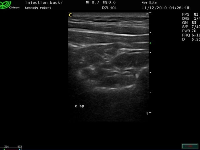 Ultrasound Guided Injectional Treatment Of Scar Tissue Bone Spurs And Neuromas Aspen