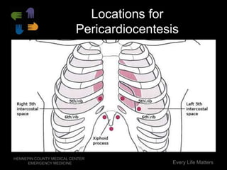 Ultrasound Guided Pericardiocentesis