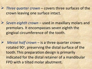 tooth preparation-partial veneers | PPT