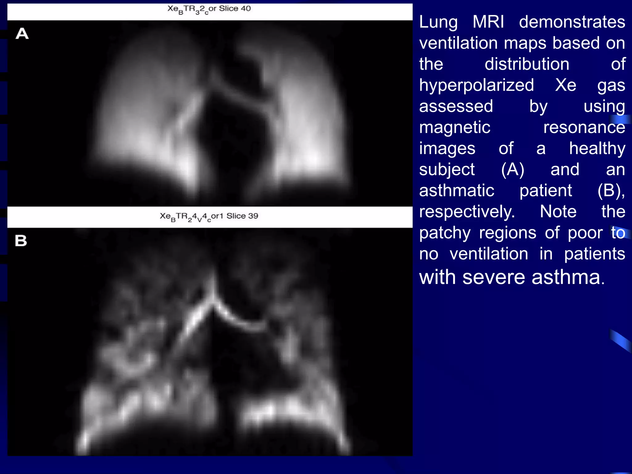 Using Imaging as a Biomarker for Asthma | PDF