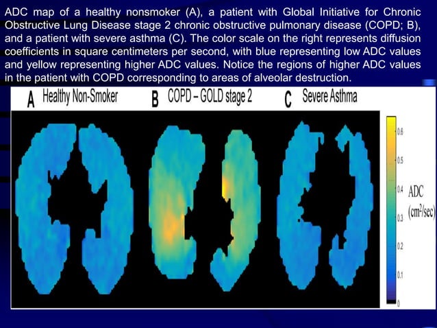 Using Imaging as a Biomarker for Asthma | PPT