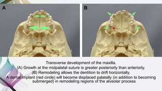 Using implants for growing patients | PPT