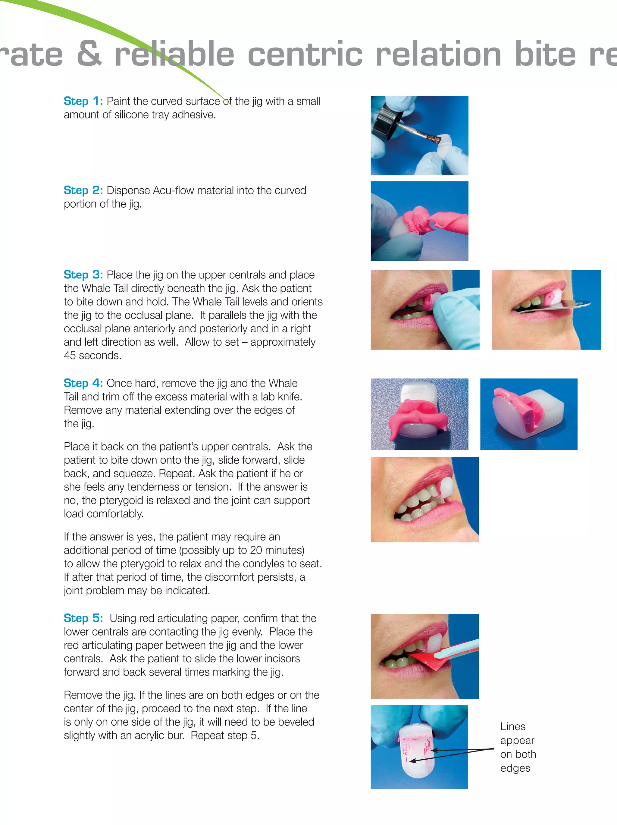 Using the lucia jig for accurate bite s220 | PDF
