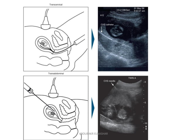 invasive procedures for prenatal diagnosis ISUOG Guidelines | PPT