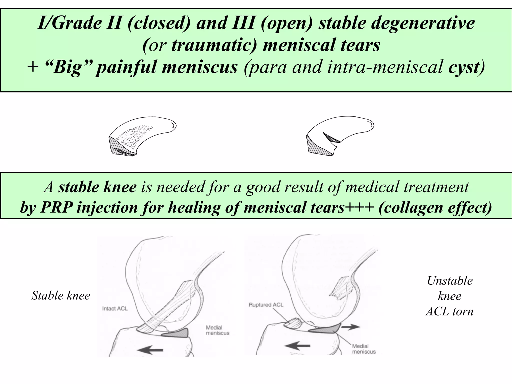 Use of PRP-HA for the Treatment of Articular and Peri-Articular ...