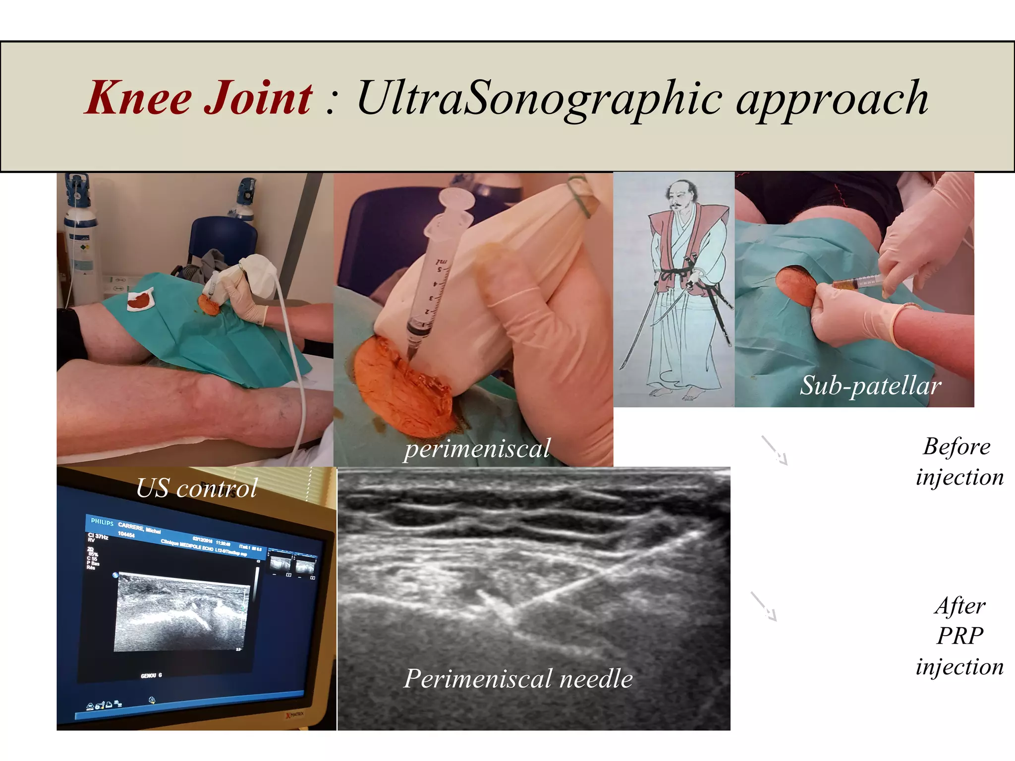 Use of PRP-HA for the Treatment of Articular and Peri-Articular ...