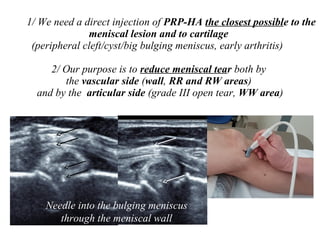 Use of PRP-HA for the Treatment of Articular and Peri-Articular ...