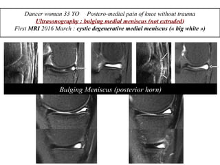 Use of PRP-HA for the Treatment of Articular and Peri-Articular ...