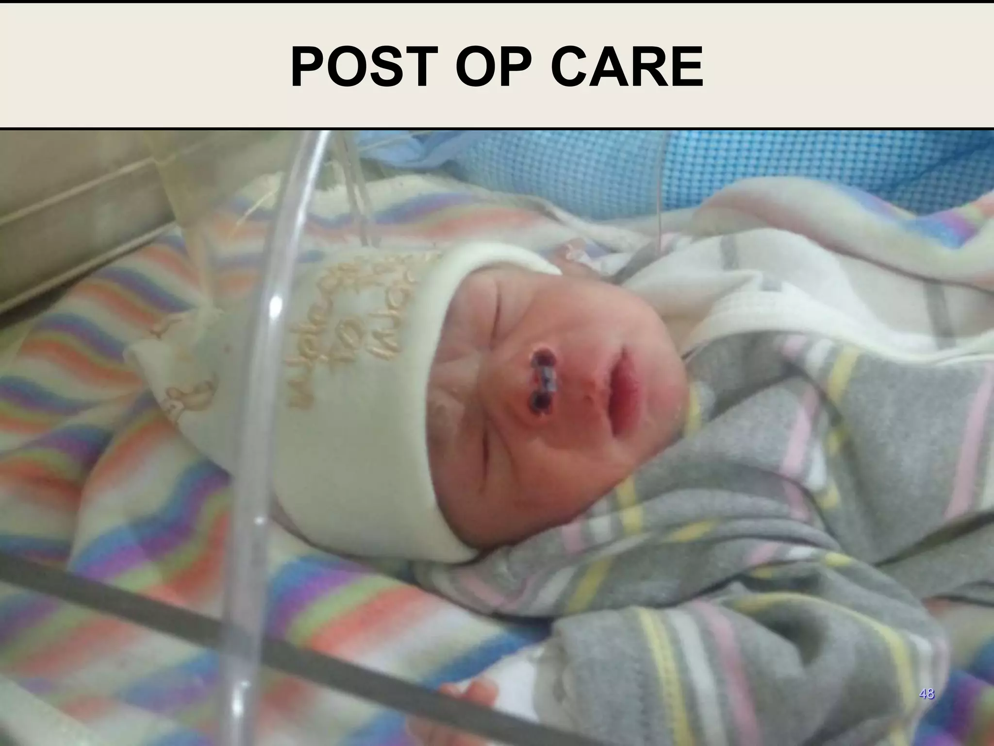 choanal atresia | PPT