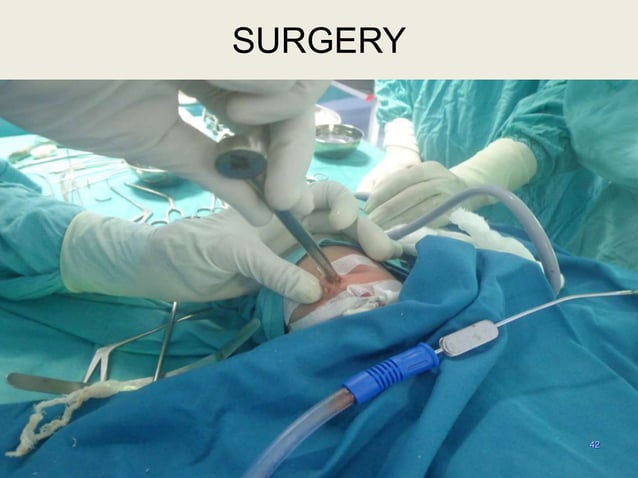 choanal atresia | PPT