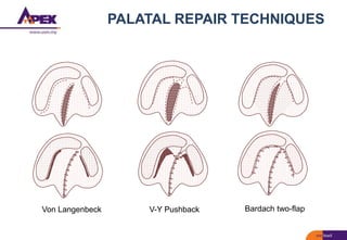 Unilateral Cleft Lip and Palate Treatment Outcome Assessment | PPT