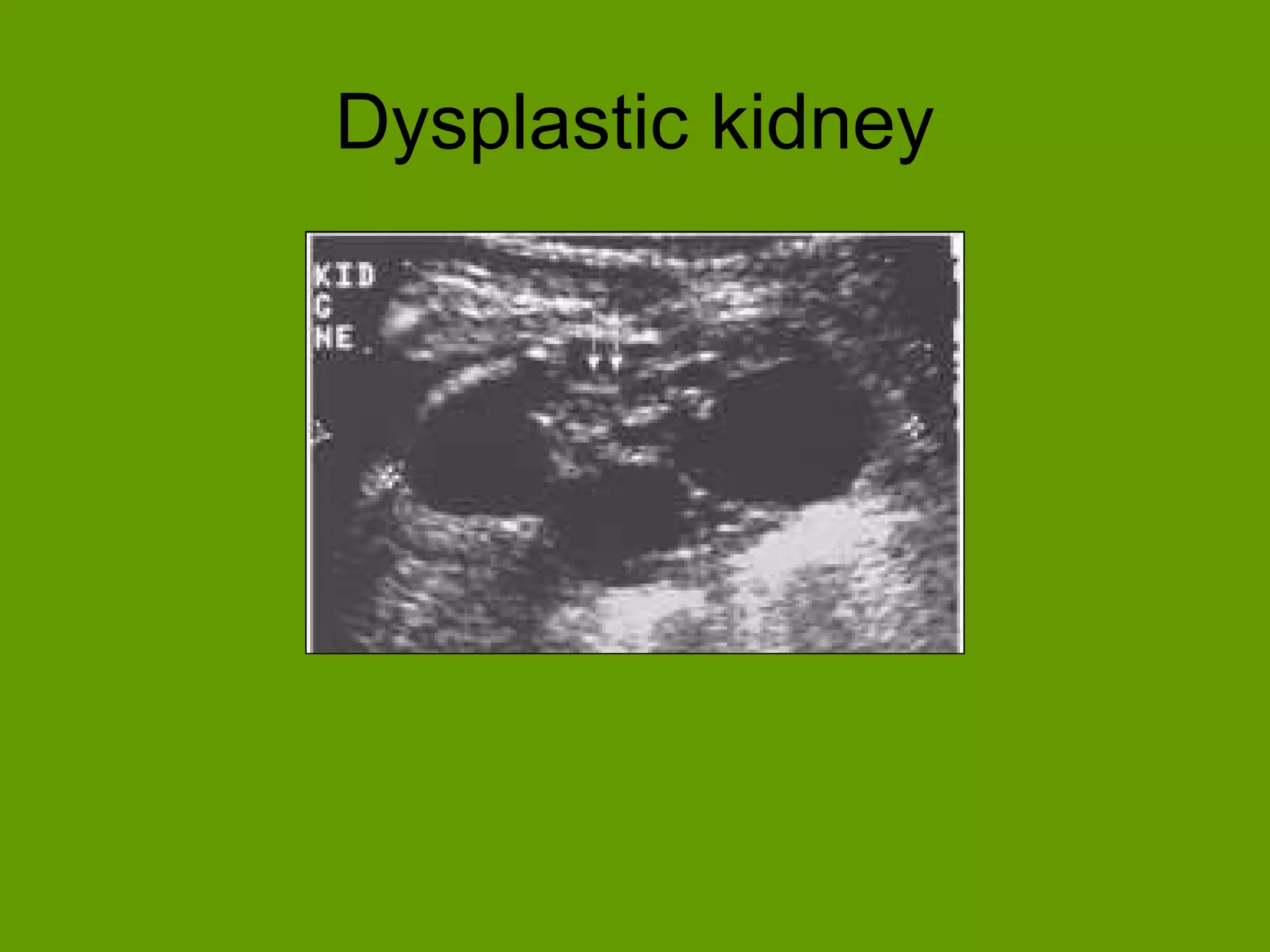 Us neonatal kidney | PPT