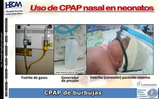 Uso de cpapn en neonatos | PDF