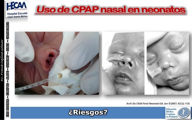 Uso de cpapn en neonatos