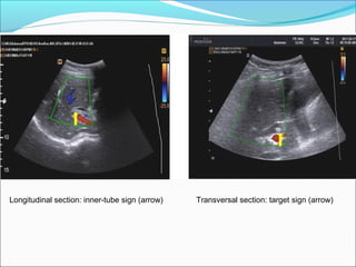 Ultrasound of CBD Ascariasis at Medic Center | PPT
