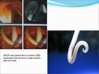 Ultrasound of CBD Ascariasis at Medic Center | PPT