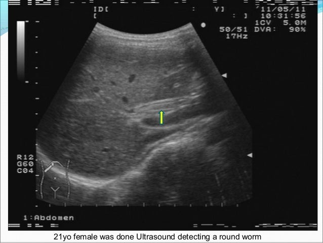 Ultrasound of CBD Ascariasis at Medic Center