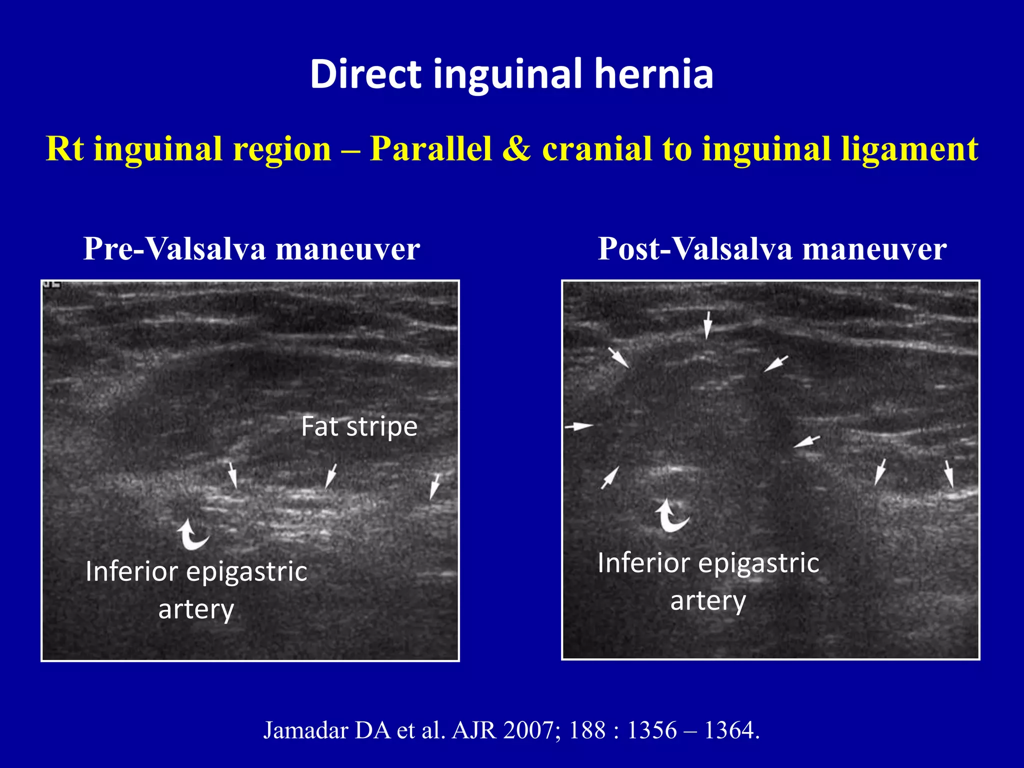 Ultrasound of the abdominal wall hernias | PPTX