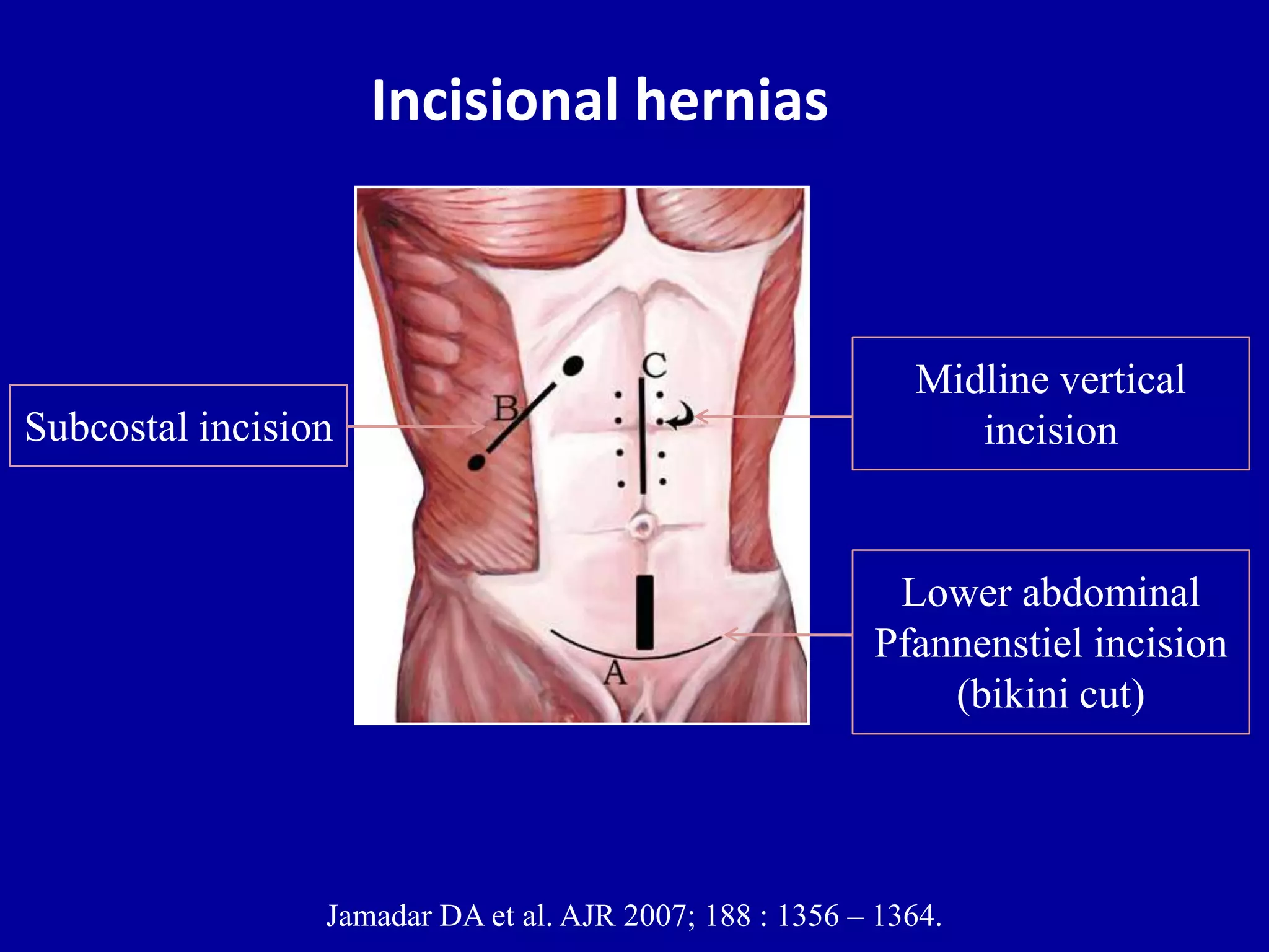 Ultrasound Of The Abdominal Wall Hernias Pptx