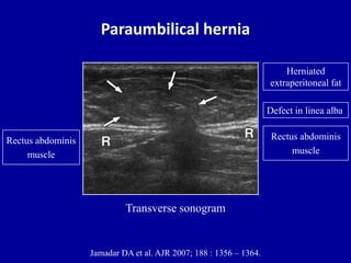 Ultrasound of the abdominal wall hernias | PPTX