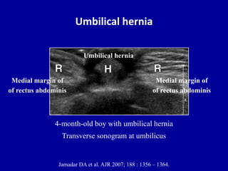 Ultrasound of the abdominal wall hernias | PPTX