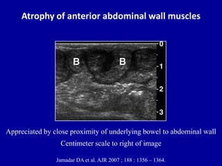 Ultrasound of the abdominal wall hernias | PPTX