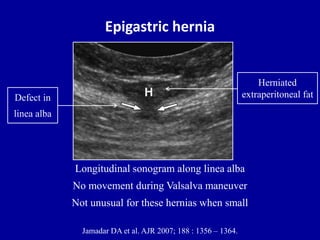 Ultrasound of the abdominal wall hernias | PPTX