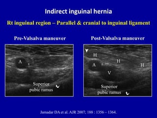 Ultrasound Groin Hernia , Ultrasound of the Groin: Techniques ...