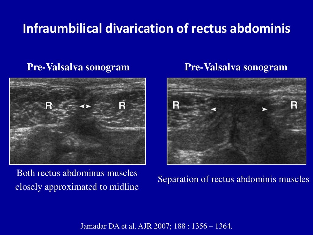 Ultrasound of the abdominal wall hernias