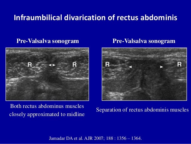 Ultrasound of the abdominal wall hernias