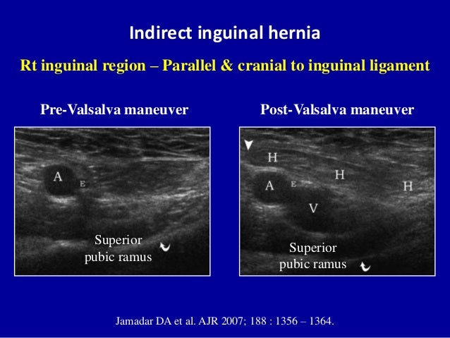 Ultrasound of the abdominal wall hernias