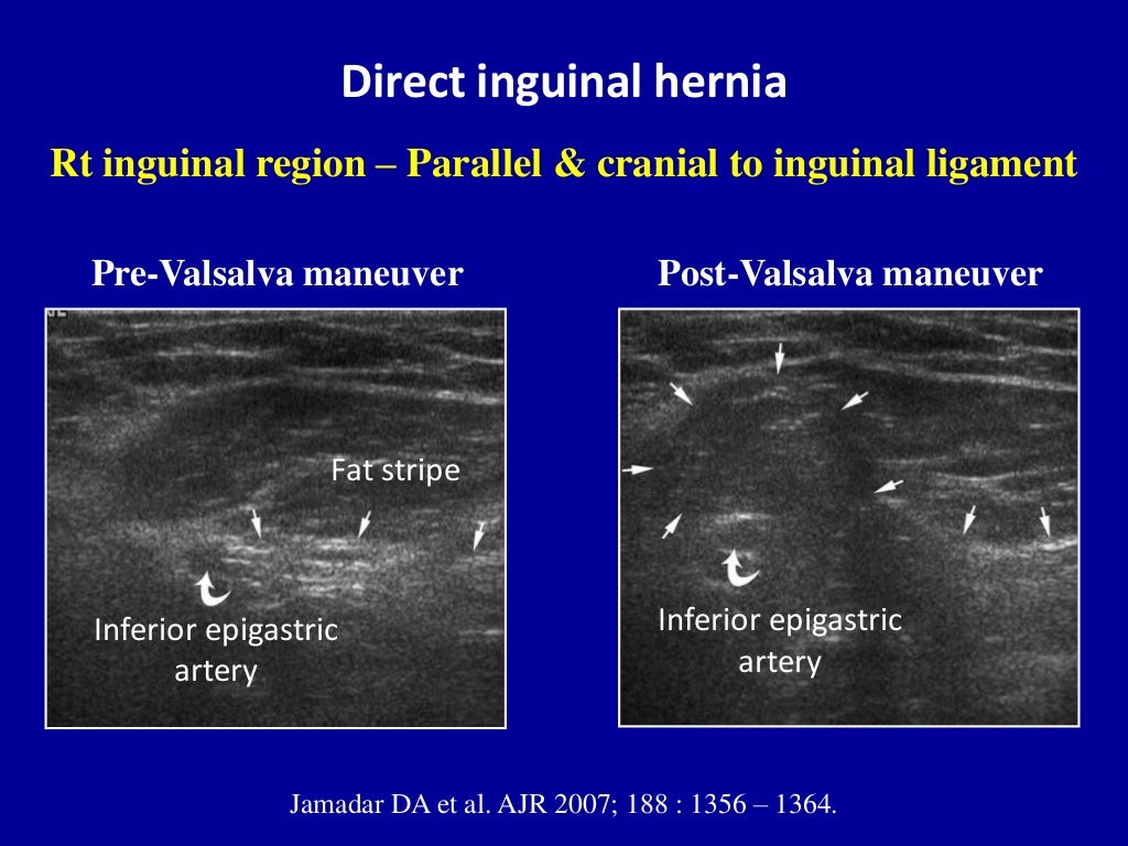 Ultrasound of the abdominal wall hernias