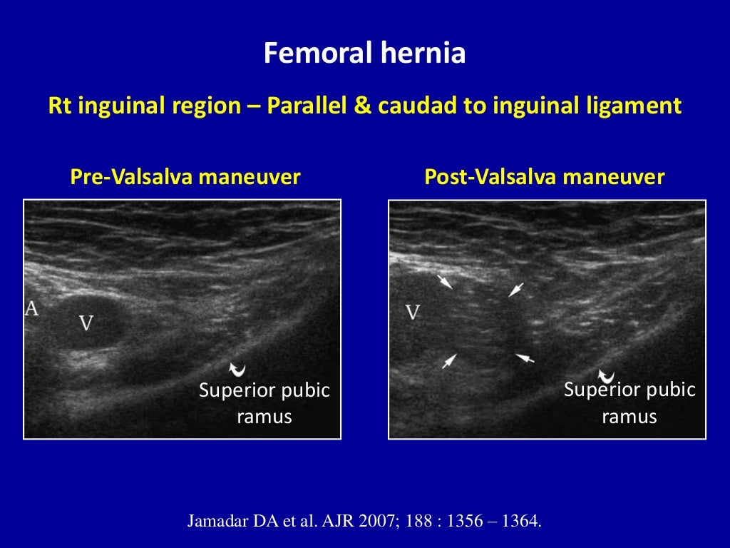 Ultrasound of the abdominal wall hernias
